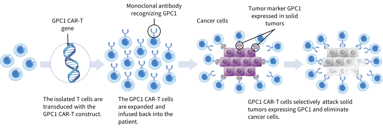 Clinical Pipeline - GPC1 CAR-T therapy
